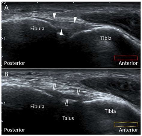 Advanced Ankle And Foot Sonoanatomy Imaging Beyond The Basics