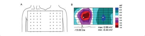 Body Surface Potential Mapping During Ventricular Depolarization In Athletes With Prolonged Pq