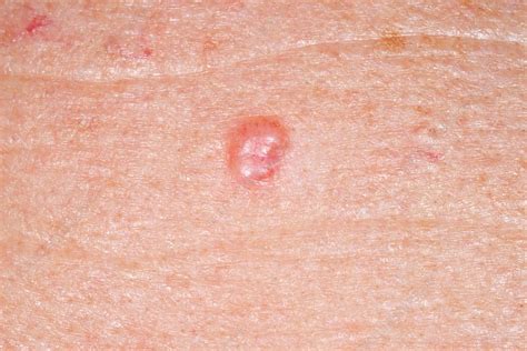 Basal Cell Carcinoma Skin Cancer Stock Image C0370923 Science Photo Library