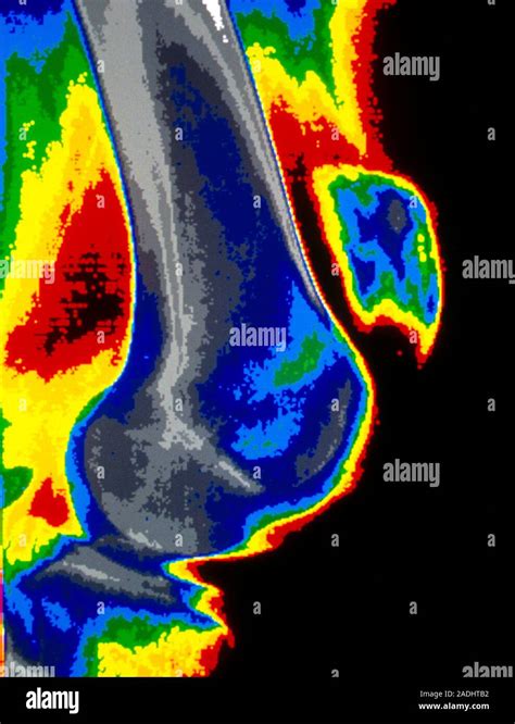 Dislocated Kneecap Coloured X Ray Of The Knee Seen From The Side