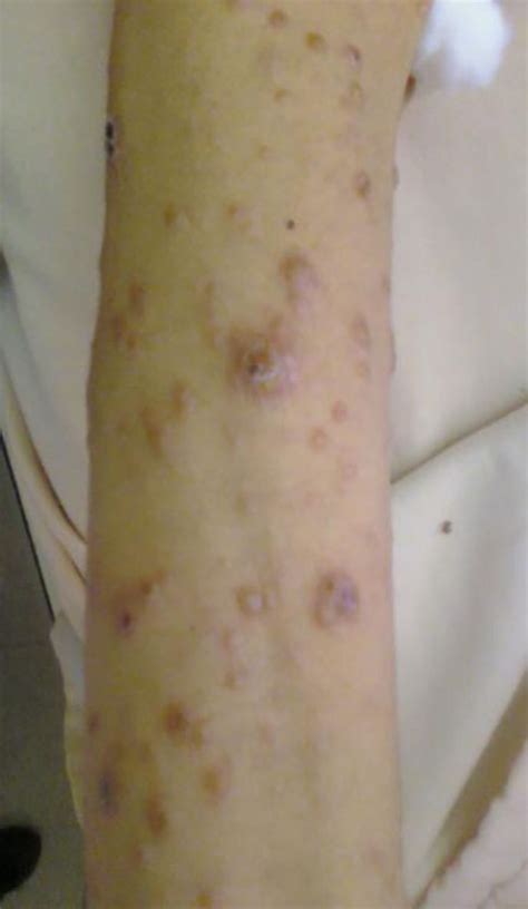 Skin Lesions Aids