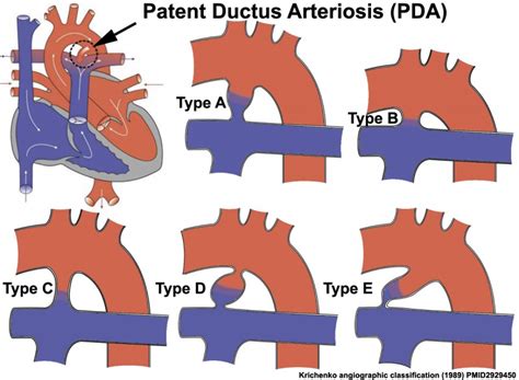 Filepatent Ductus Arteriosus Classification Embryology