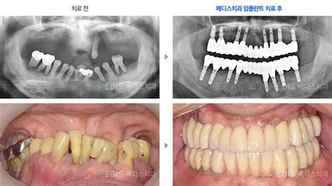 임플란트 전체 임플란트 식립 사례 부산서면치과 I 서면 메디스치과
