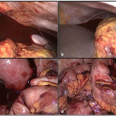 Pdf Laparoscopic Treatment Of Mesenteric Avulsion And Intestinal