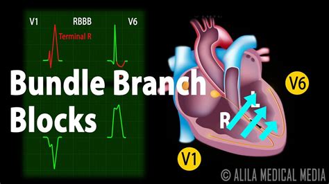 Right Bundle Branch Block