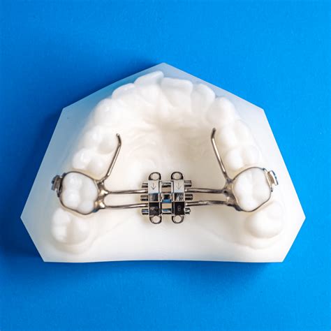 Mse Expander Ordont Orthodontic Appliance Lab