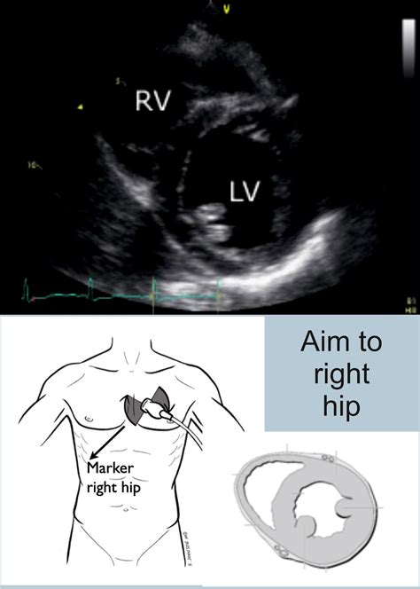 Adult Emergency Medicine Echo In Life Support