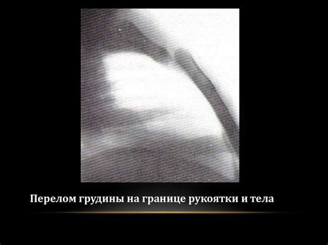 Травмы груди и живота - online presentation