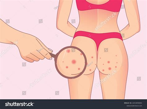 Buttocks Red Pimples Skin Bubble Rash Stock Vector Royalty Free 2253459041 Shutterstock