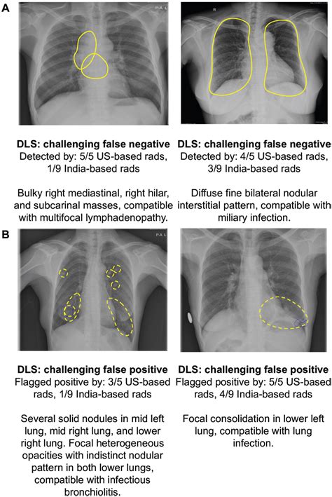 Deep Learning Detection Of Active Pulmonary Tuberculosis At Chest