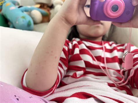 아기 풀독 두드러기같은 증상 연고 치료 방법 네이버 블로그