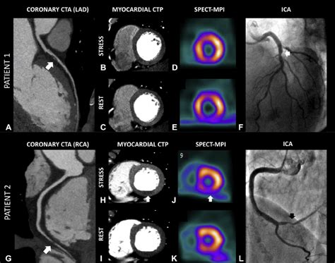 E Combining CTA And CTP Data In Diagnostic Of Flow Limiting Stenosis Download Scientific
