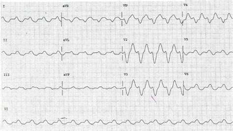 Ecg Challenge Hypotension In A Cardiomyopathy Patient