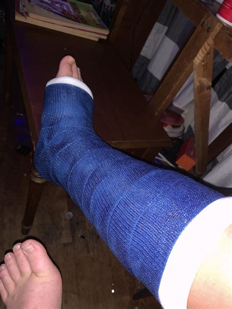 Tibia Fracture R Brokeabone