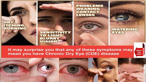 Let S Simplify DRY EYE SYNDROME EXPLAINED In Detail For Medical