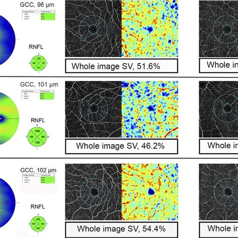 Oct Macular Gcc Thicknesses In Healthy Naion And Papilledema Eyes Download Table