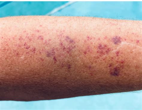 Recognizing Skin Symptoms In Leukemia Patients Healthtree For Chronic