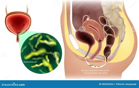 Abacterial Cystitis Stock Illustrations 1 Abacterial Cystitis Stock Illustrations Vectors