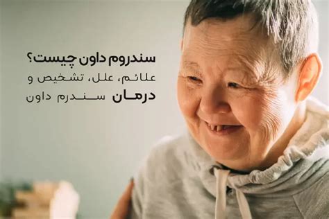 سندروم داون Down Syndrome چیست؟ علائم، علل، تشخیص و درمان سندرم