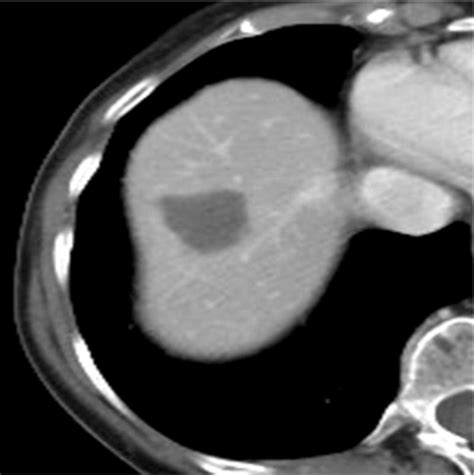 Hepatic Artery Embolization For Liver Metastasis Of Gastrointestinal Stromal Tumor Following