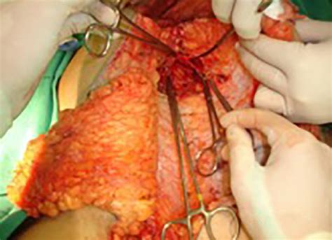 Abdominal Wall Defect In The Periumbilical Region And Detached Flap