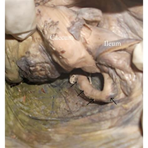 Position Of The Appendix Arrow A Retrocecal Appendix Note The