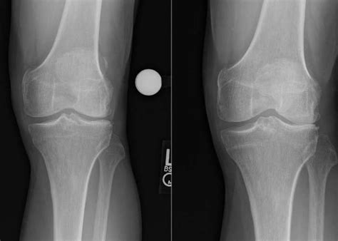 Lateral Meniscus Tear Complex Knee Surgeon Minnesota