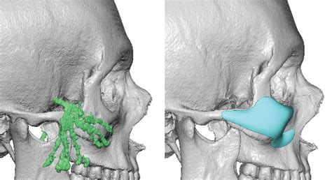 Custom Midface Implants Cheek Implants Eppley Custom Facial Implants