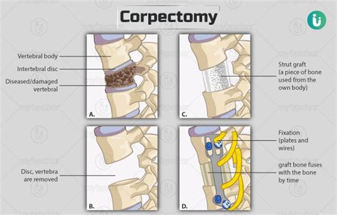 Corpectomy Procedure Purpose Results Cost Price