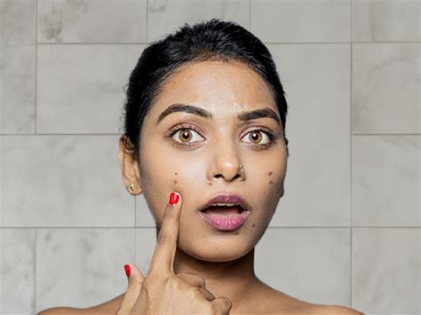 Shocking Difference Between Acne And Pimples MFine