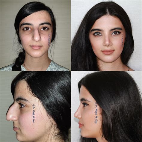 Back To The Work Rhinoplasty Art Modern Burun Estetiği Facebook