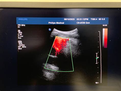 Philips C9 4 Curved Array Ultrasound Transducer Probe Iu22 Auschoice