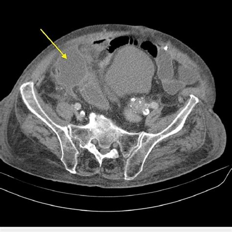 Ct Scan Showing Perforated Gallbladder Arrow Ct Computed Tomography Download Scientific Diagram