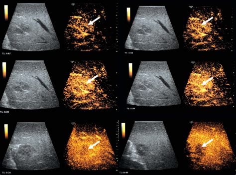 Detection And Characterization Of A Malignant Lesion By Ce Ious With A