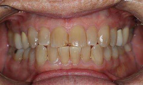 Upper Arch Restoration Before And After Photos Irvine Ca