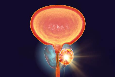 Diabetes Drug Stops Prostate Cancer From Coming Back