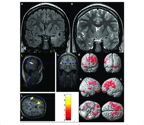 Atypical Language Dominance In A Patient With Focal Cortical Download Scientific Diagram