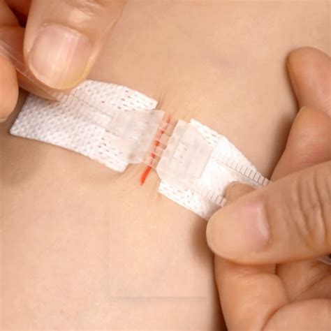 Huawei Medical Wound Closure Strip Emergency Sterile Strips For Wound