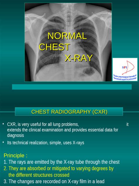 Normal Cxr Pdf