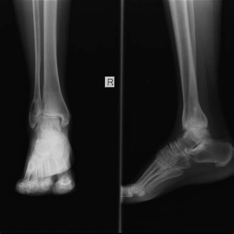 Hemorrhagic Fracture Blisters In A Patient With A Highenergy Injury