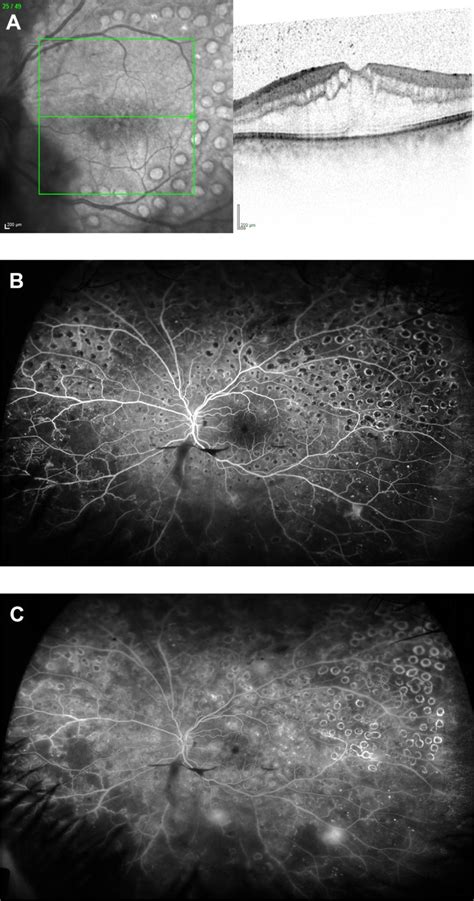 Patient With Diffuse Diabetic Macular Edema A Note The Laser Spots Download Scientific