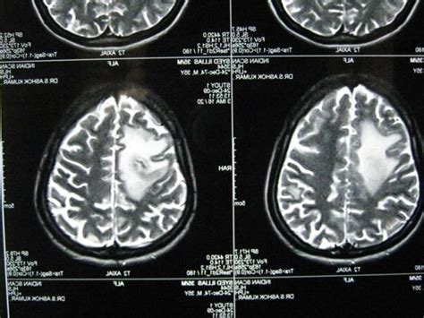 Ct Ring Enhancing Lesion Pptx