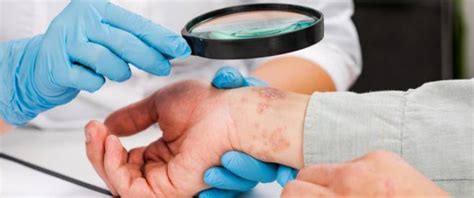 العدوى الفطرية أكثر الأمراض الجلدية شيوعاً خلال موسم الأمطار جريدة