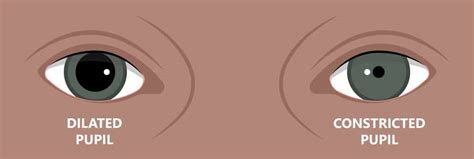 Pupil Size And Drug Use When Anisocoria Signals A Bigger Problem