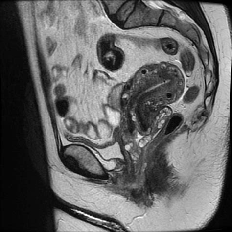 Sagittal T2 Weighted Magnetic Resonance Image Of The Pelvis
