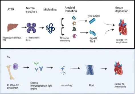 32 Cardiac Amyloidosis With Dominant Autonomic Involvement Heart