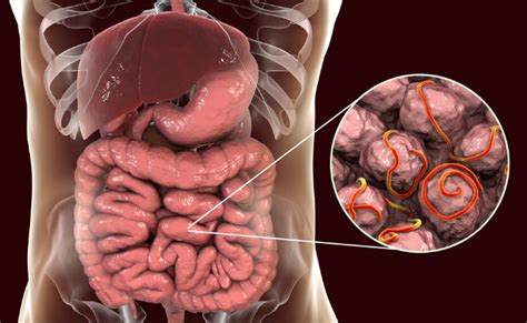 Isosporiasis Causes Symptoms And Treatment