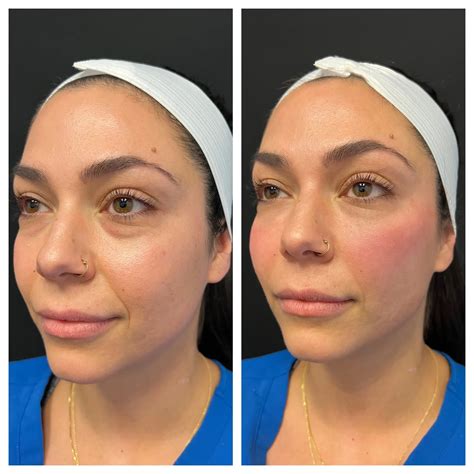 Botox Injections For Hyperhidrosis Say Goodbye To Sweat