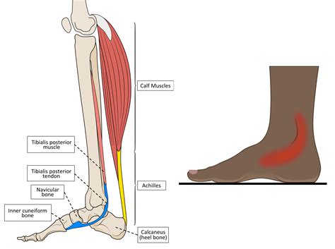 Tibialis Posterior Dysfunction Tpd Is A Pain In The ‘ankle And ‘arch