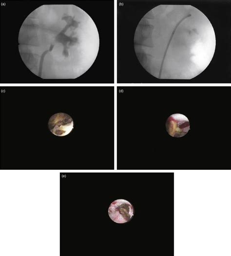 Diagnostic Ureteroscopy Abdominal Key